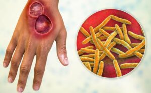 La úlcera de Buruli y sus devastadores efectos en la piel | Gaceta de ...